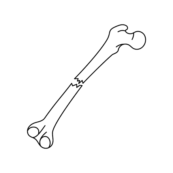 Broken Bone Theory: The Surprising Secret to Becoming Stronger